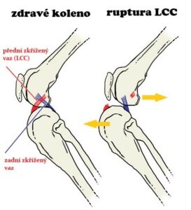 Přetržený přední zkřížený vaz v koleni. Operace kolene metodou TPLO ...